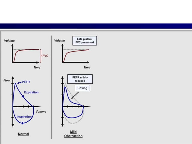 Interpretation of Pulmonary Function Test | PPTX | Lung and Respiratory ...