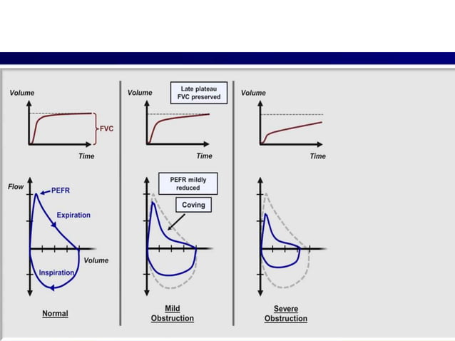 Interpretation of Pulmonary Function Test | PPTX | Lung and Respiratory ...