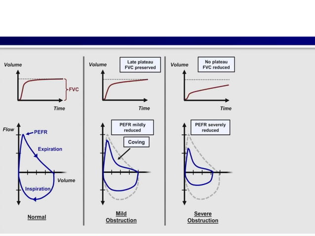 Interpretation of Pulmonary Function Test | PPTX | Lung and Respiratory ...