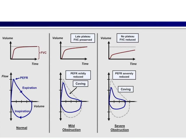 Interpretation of Pulmonary Function Test | PPTX | Lung and Respiratory ...