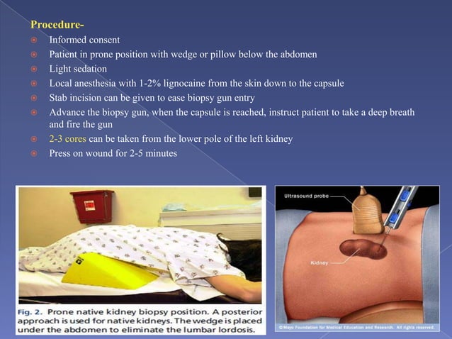 Interpretation of renal biopsy | PPTX