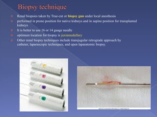 Renal Biopsy Gun