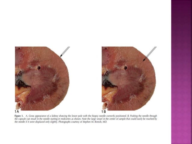 Interpretation of Renal Biopsy | PPT
