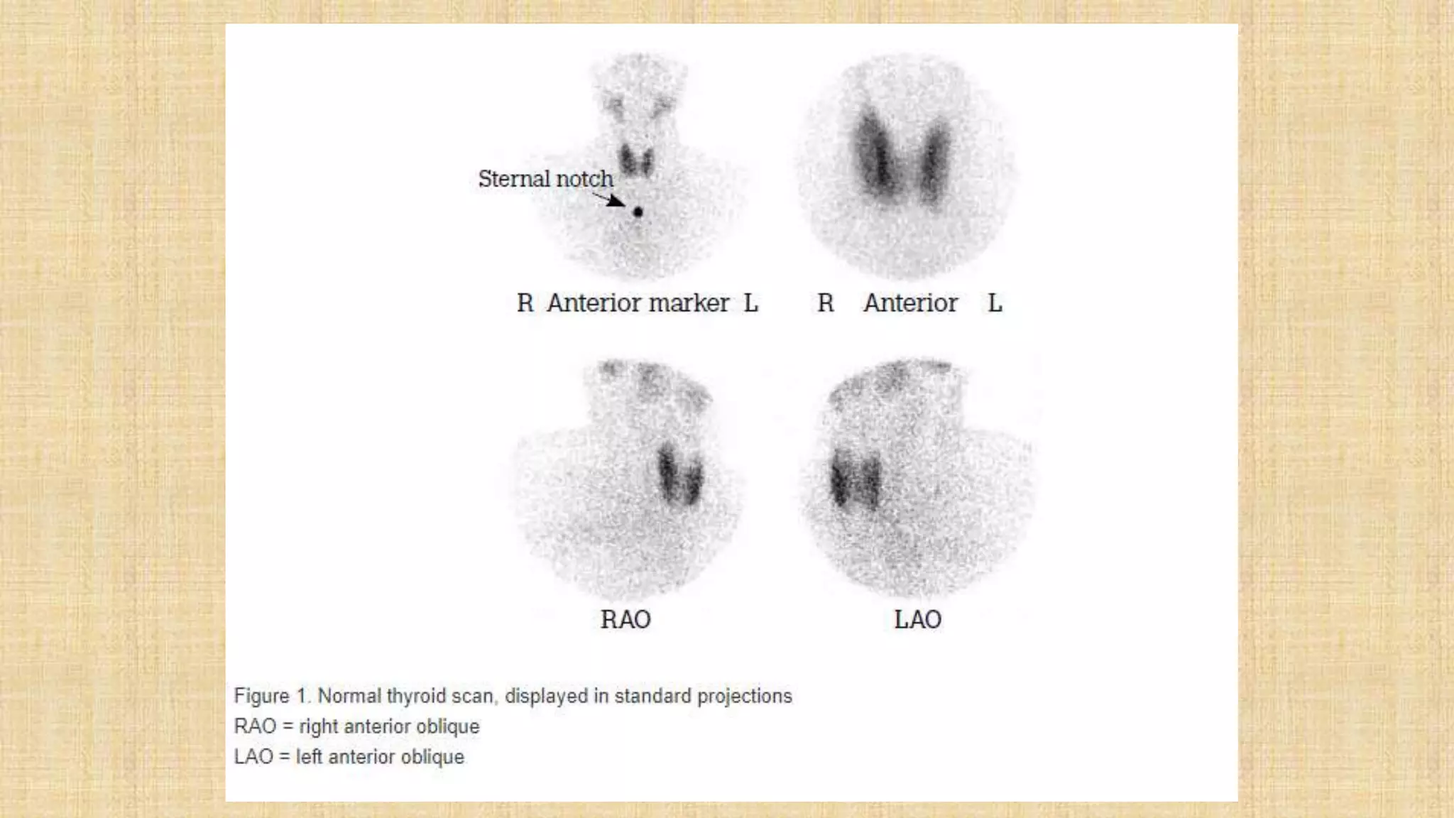 Interpretation Of Thyroid Function Tests And Scanpptx Thyroid Disorders Endocrine And