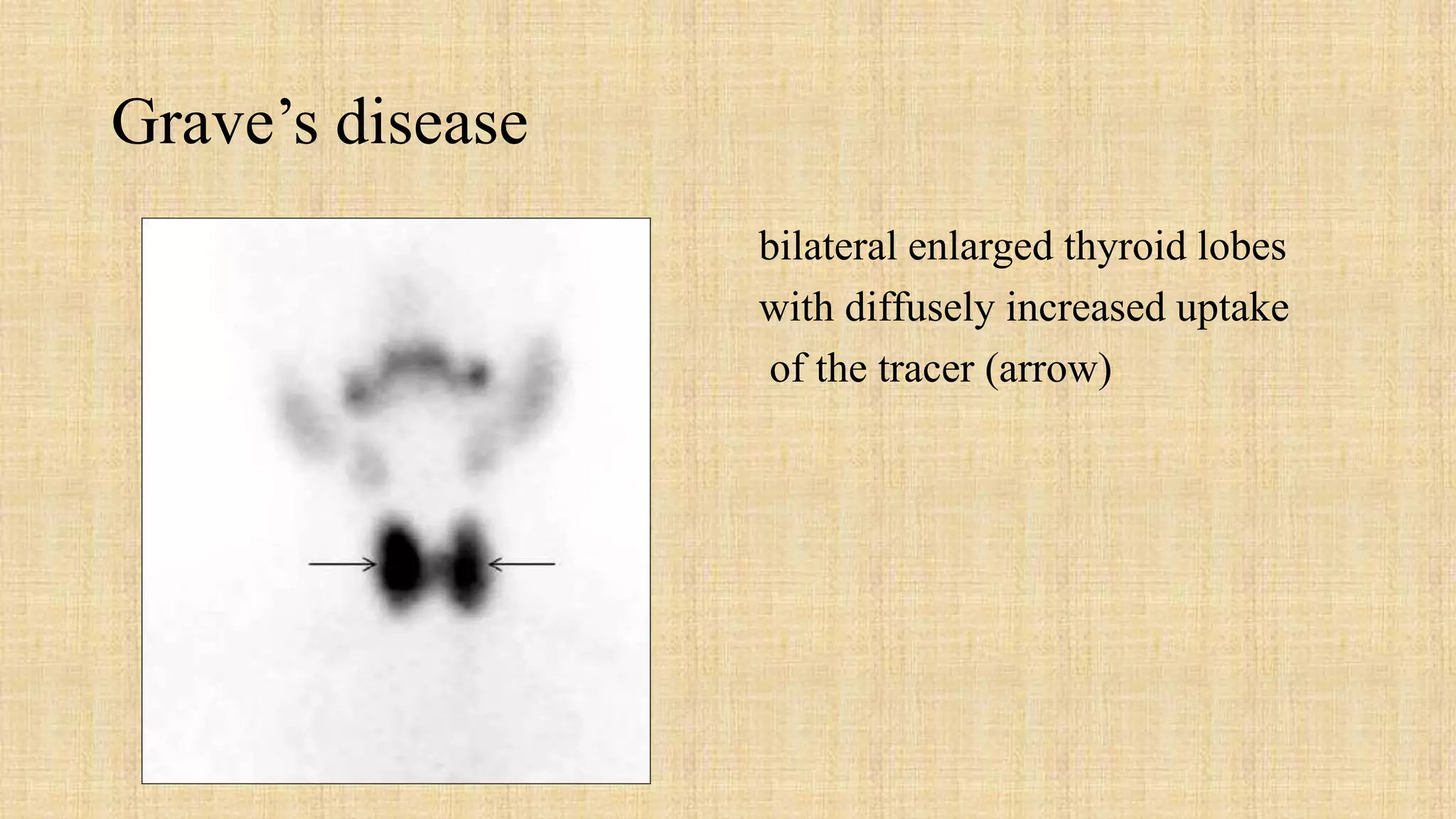 Interpretation of Thyroid Function Tests and Scan.pptx