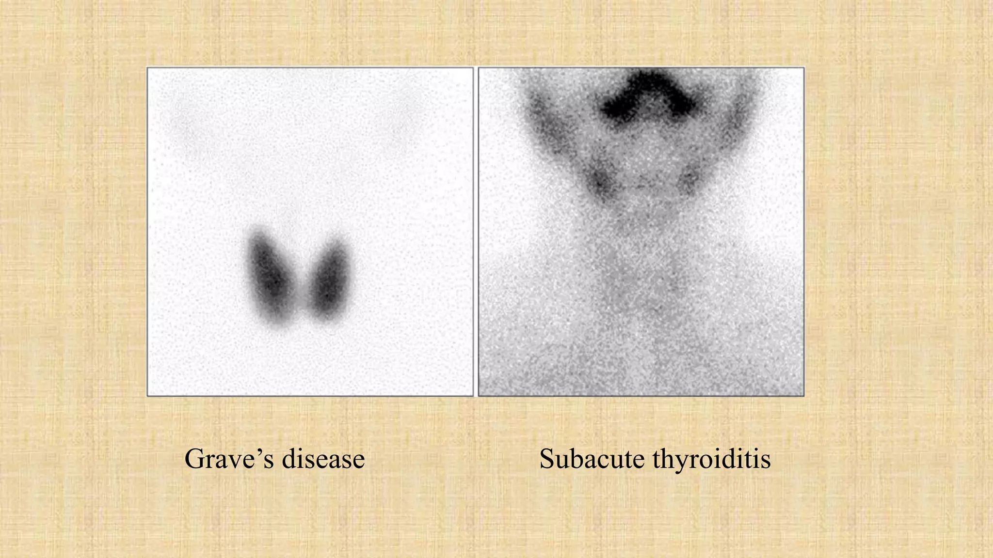 Interpretation Of Thyroid Function Tests And Scanpptx Thyroid Disorders Endocrine And