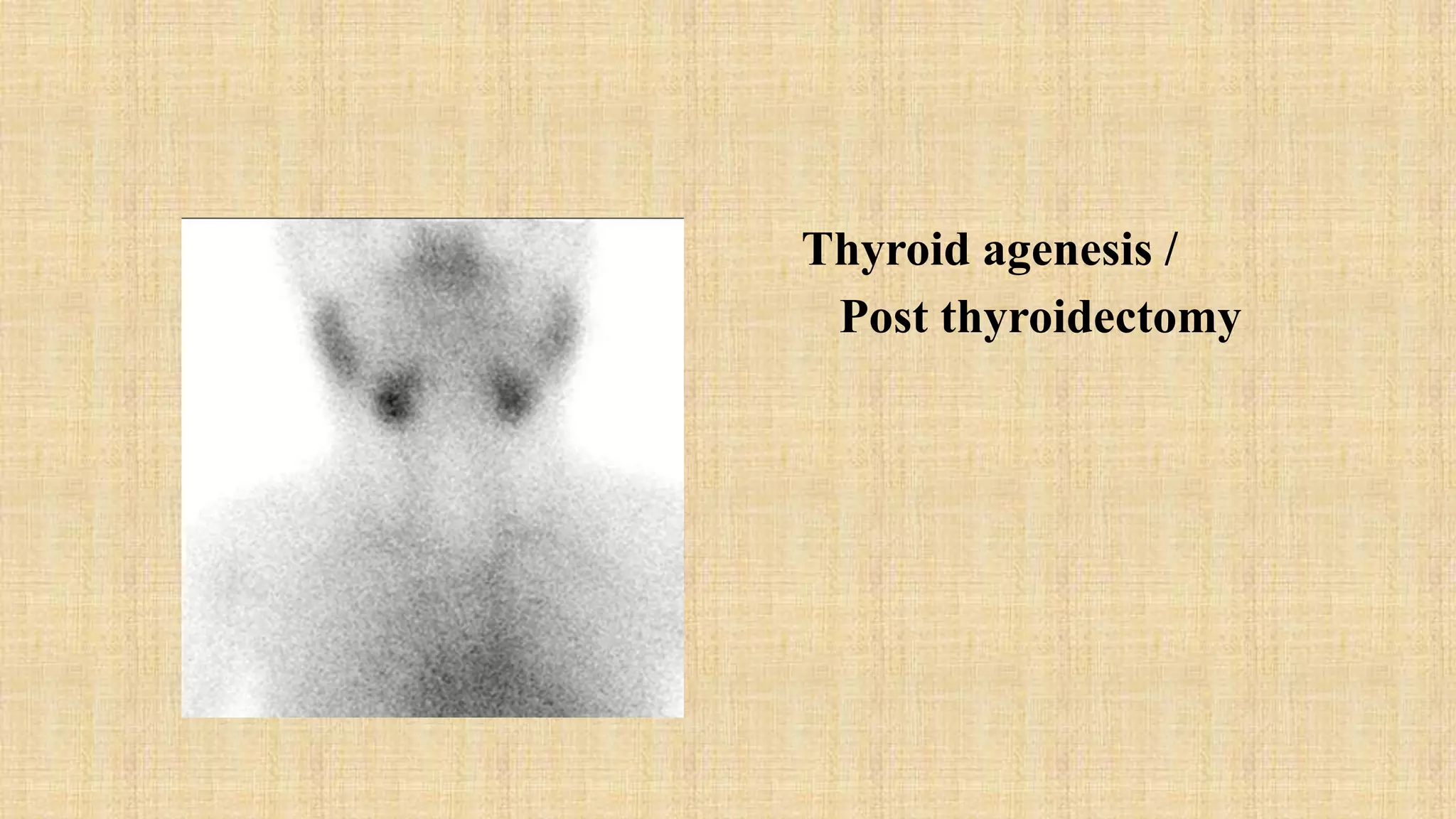 Interpretation Of Thyroid Function Tests And Scanpptx Thyroid Disorders Endocrine And