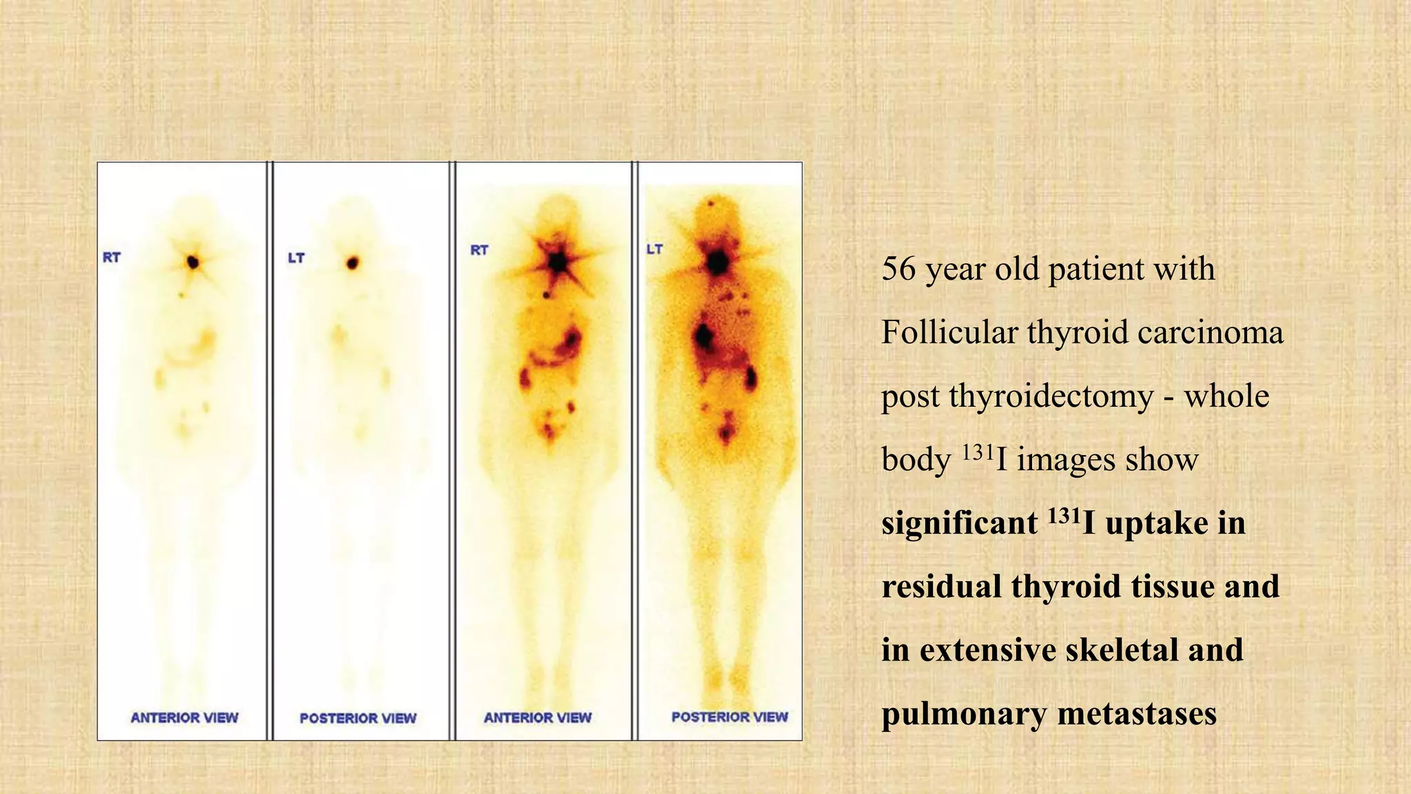 Interpretation of Thyroid Function Tests and Scan.pptx