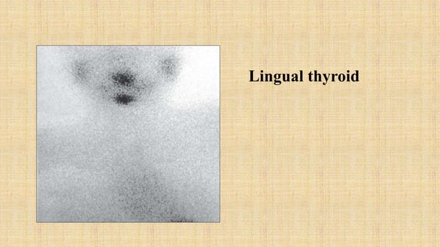 Interpretation Of Thyroid Function Tests And Scanpptx Thyroid Disorders Endocrine And