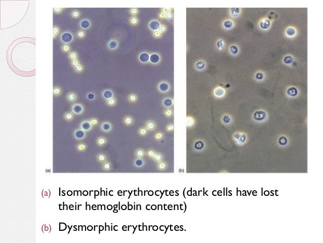 Urine Interpretation / Test / Analysis