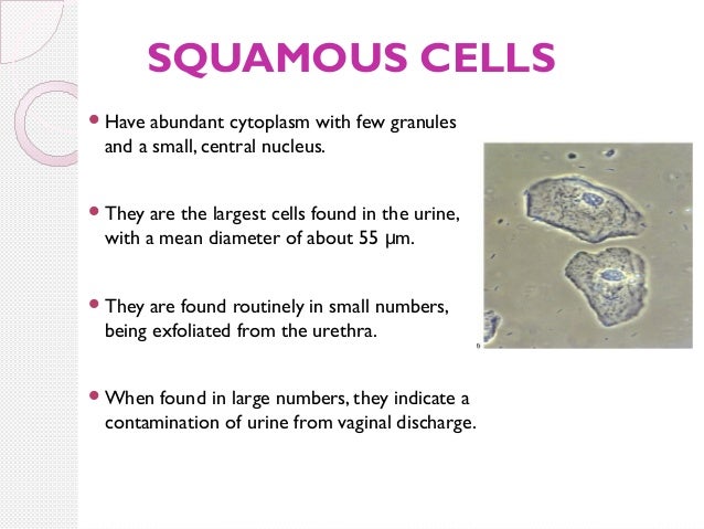 Squamous Epithelial Cells In Urine What Does It Mean