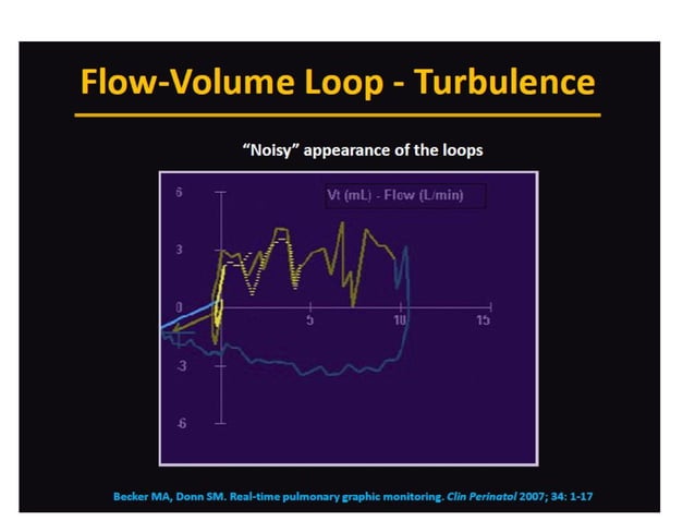 Interpretation of ventilator graphics | PPT Interpretation of ventilator graphics | PPT