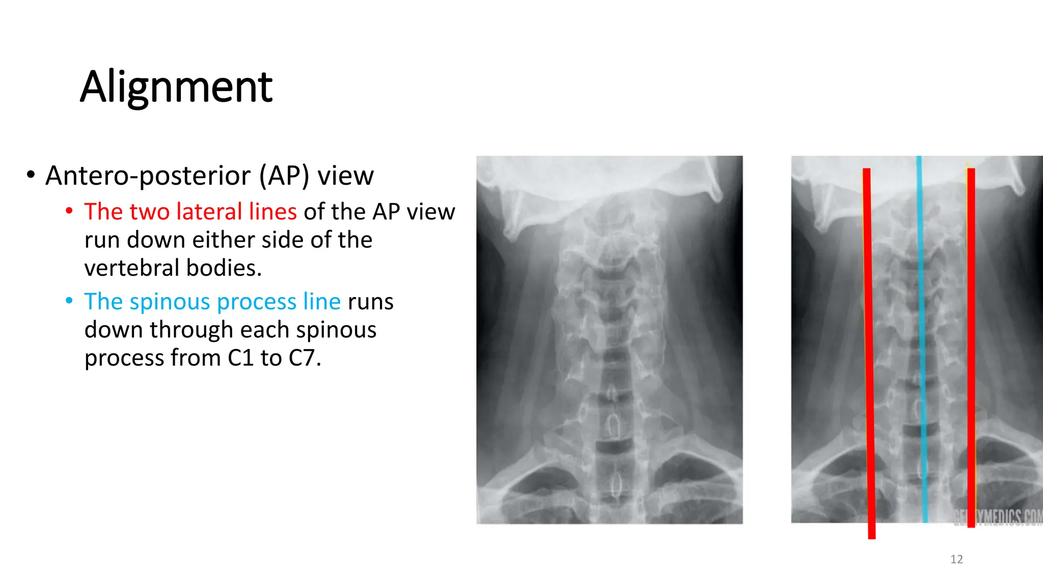Interpretation of Xrays of the spine.pptx