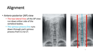 Interpretation of Xrays of the spine.pptx