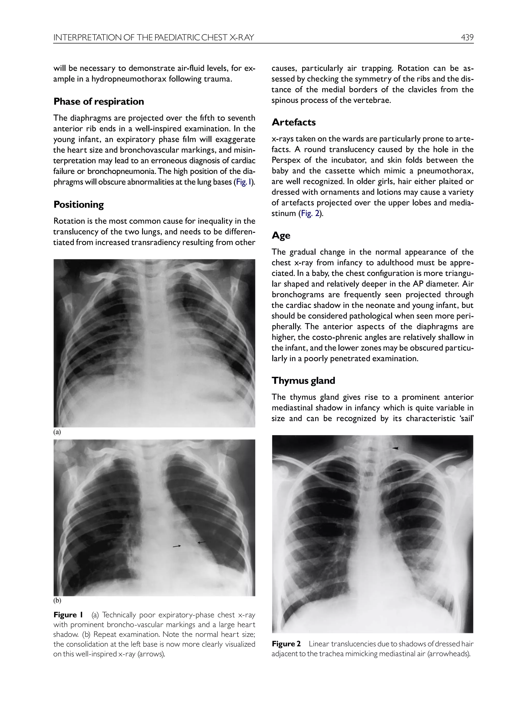 Interpretation Of The Paediatric Chest X Ray Pdf
