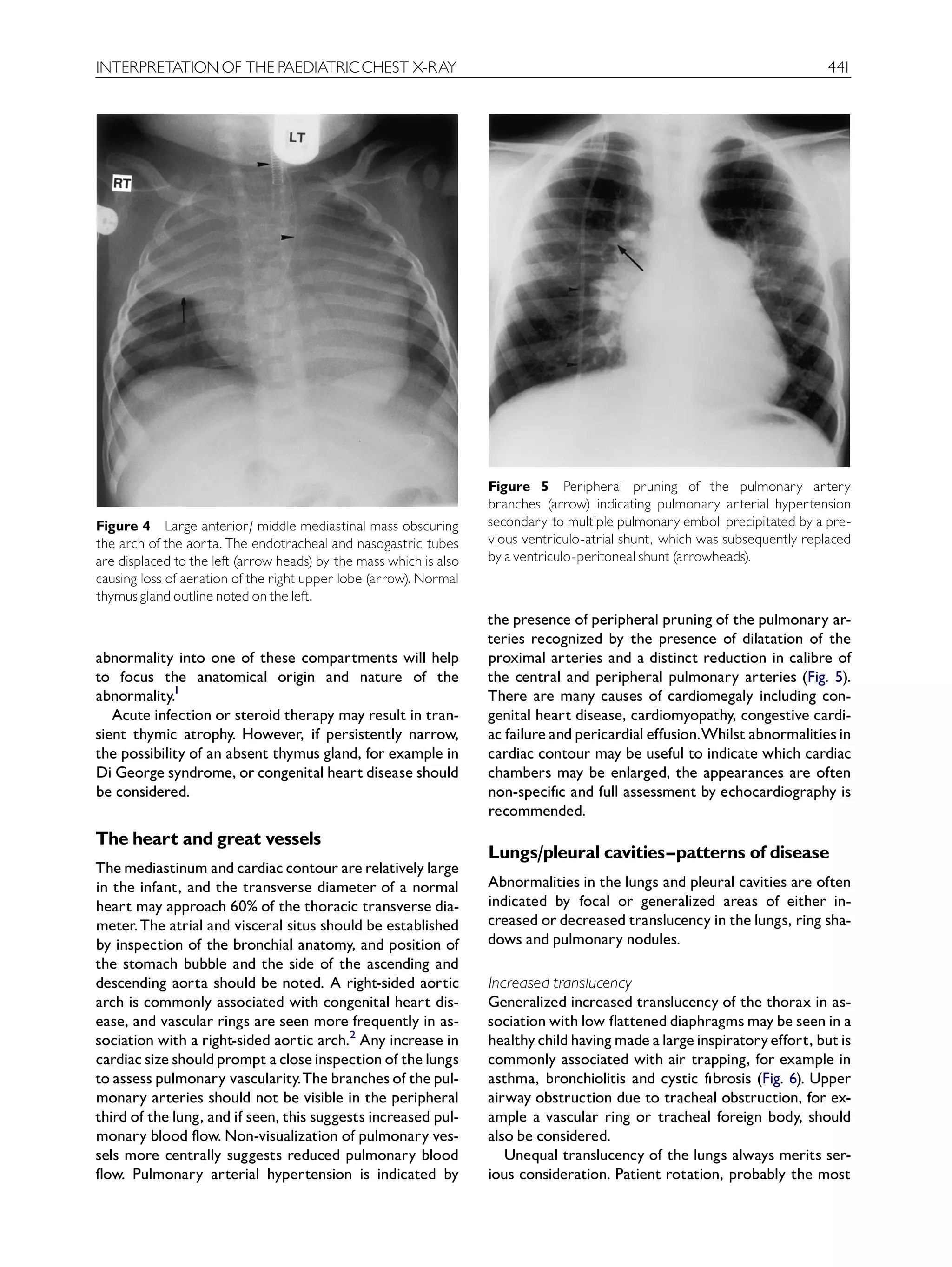 Interpretation of the paediatric chest x-ray | PDF