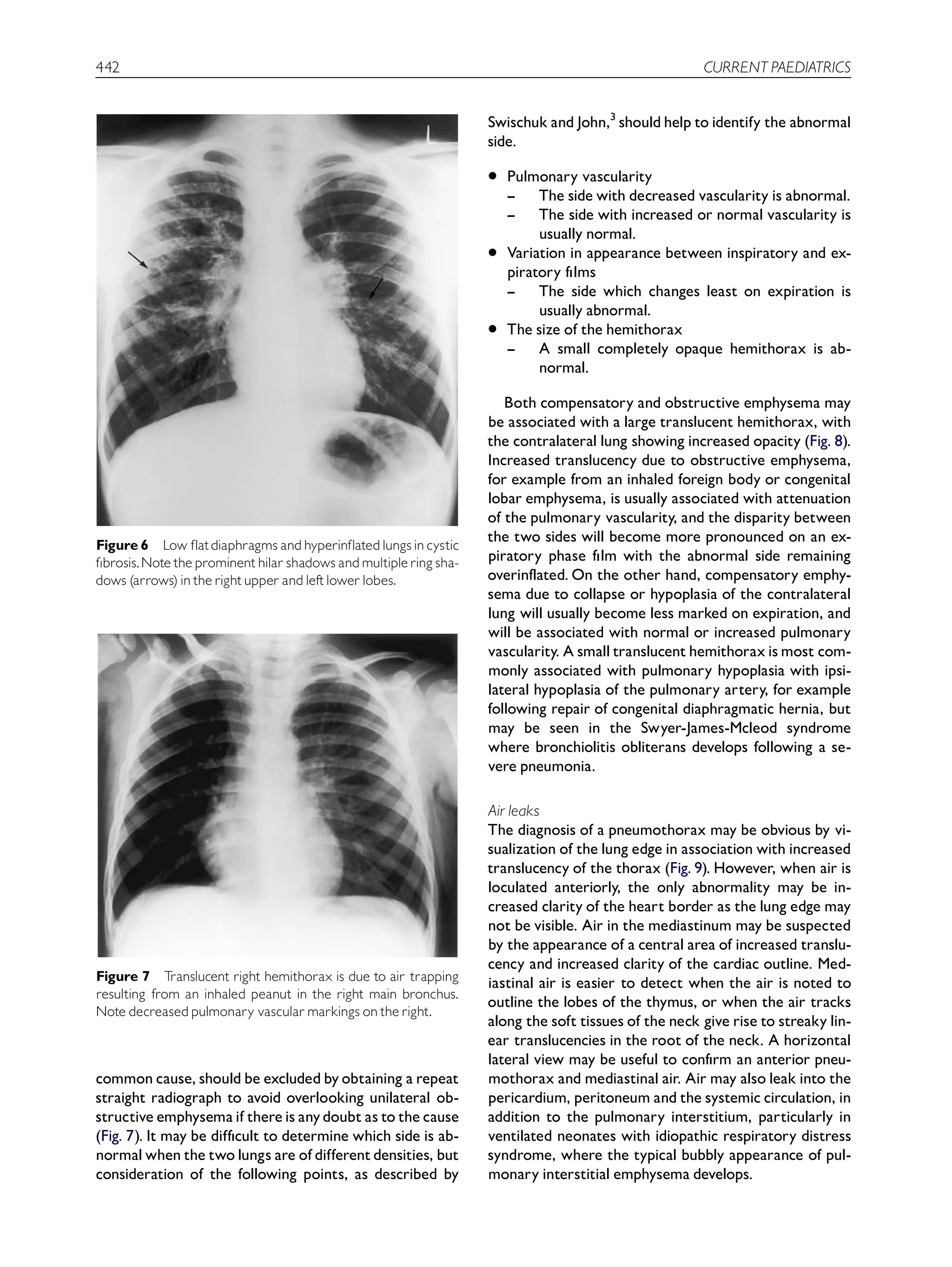 Interpretation of the paediatric chest x-ray | PDF