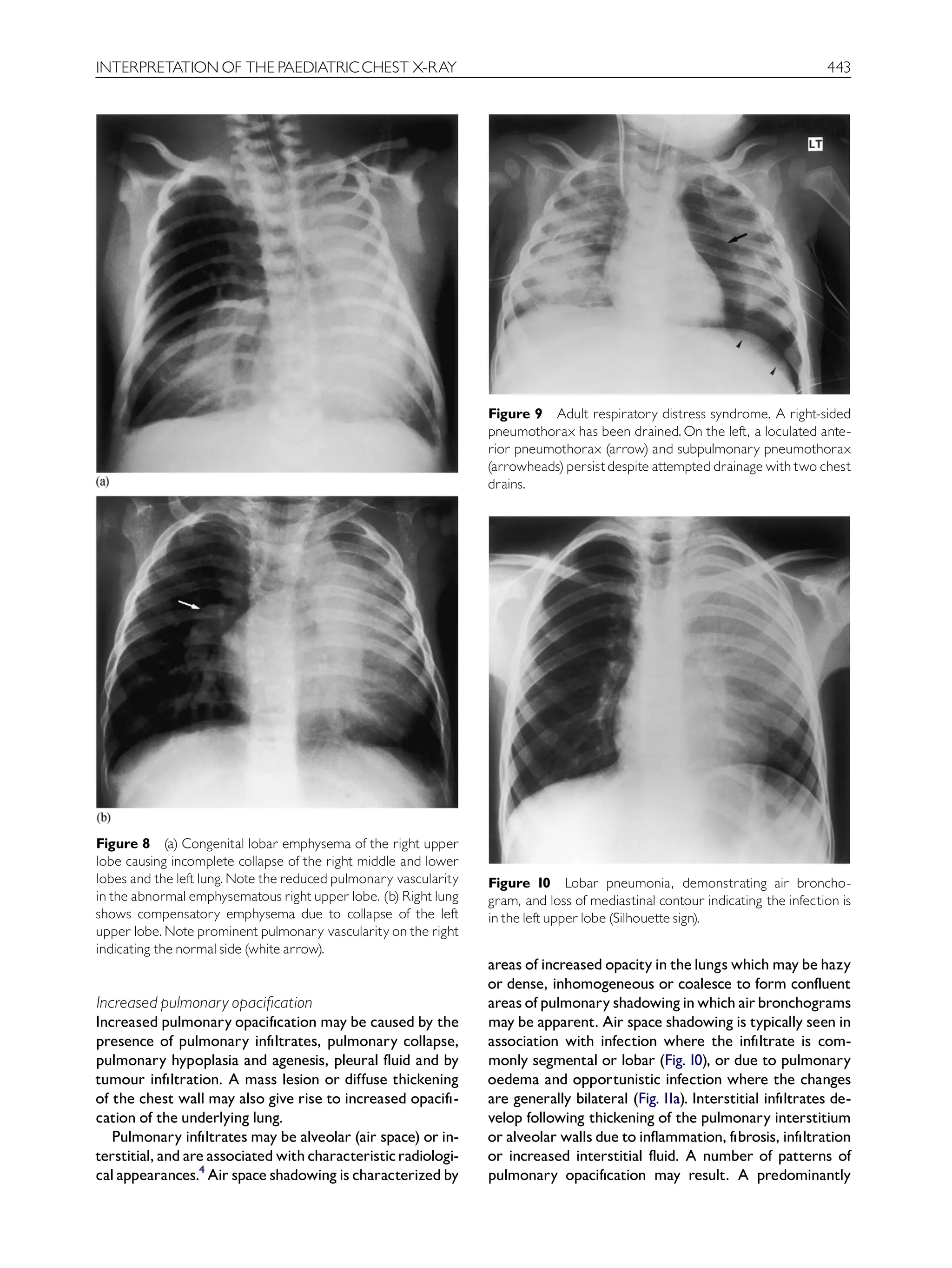 Interpretation of the paediatric chest x-ray | PDF