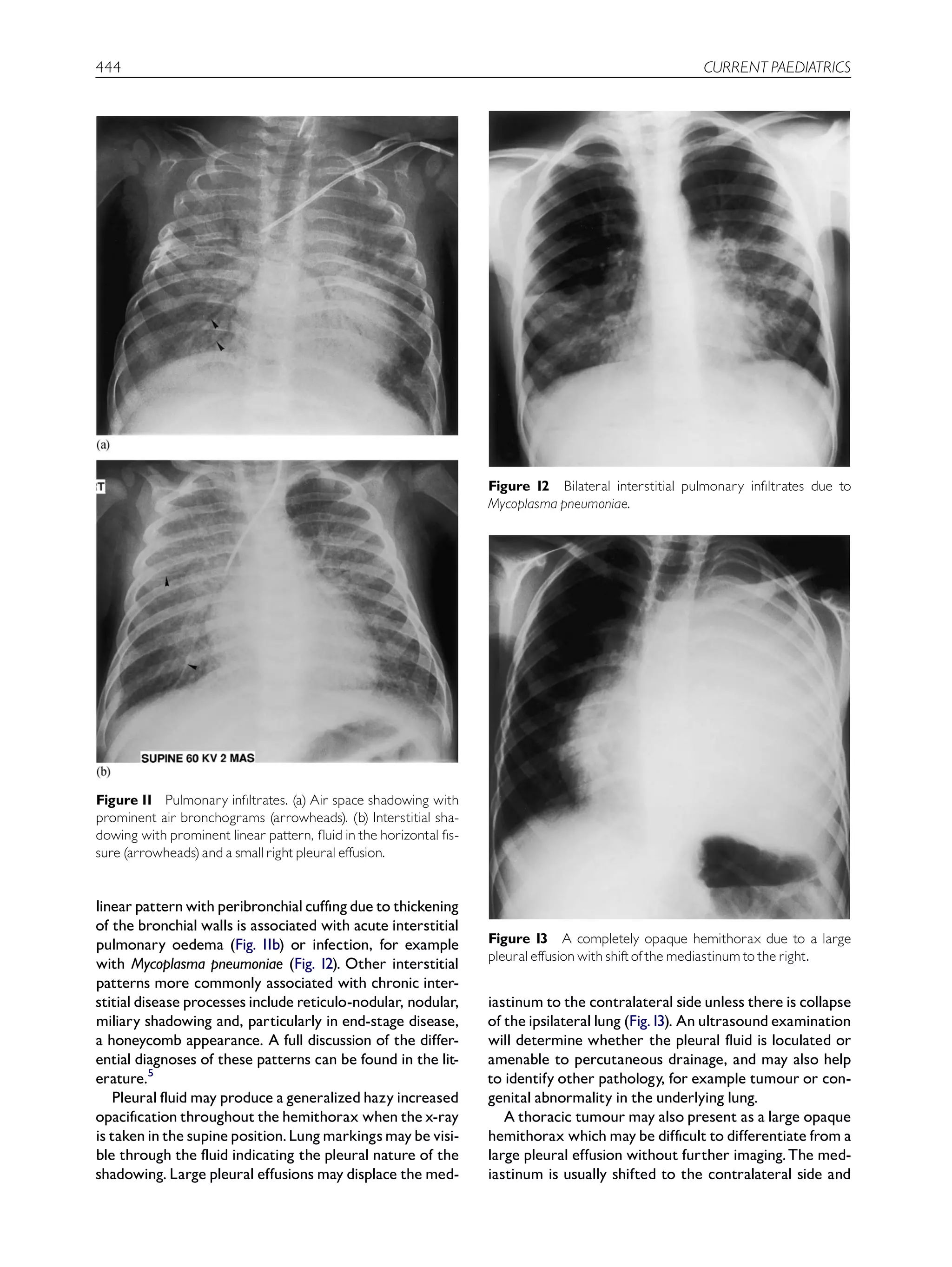 Interpretation of the paediatric chest x-ray | PDF