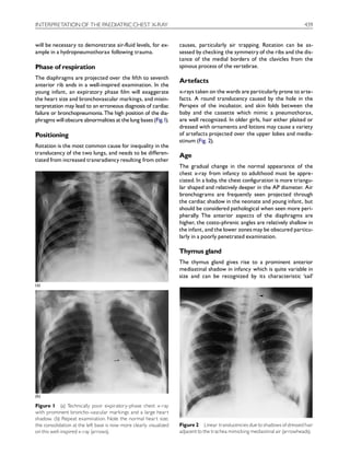 Interpretation of the paediatric chest x-ray | PDF