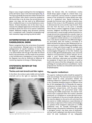 Interpretation of the paediatric chest x-ray | PDF