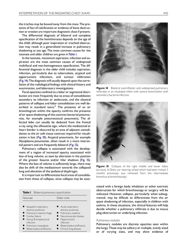 Interpretation of the paediatric chest x-ray | PDF