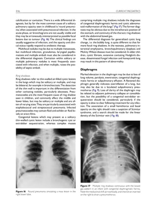 Interpretation of the paediatric chest x-ray | PDF