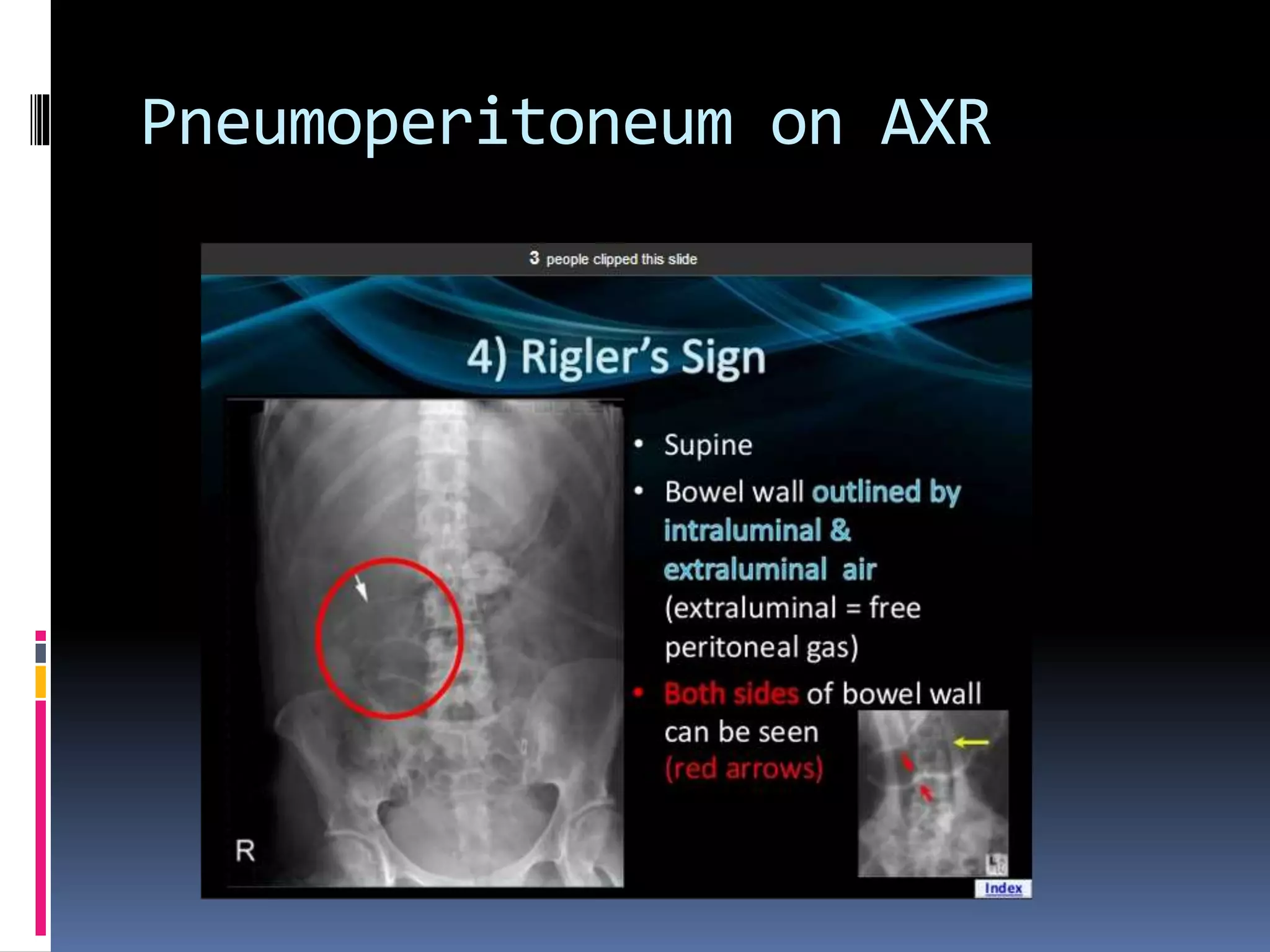 Interpret axr and imaging of gist system | PPTX