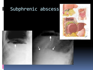 Interpret axr and imaging of gist system | PPTX