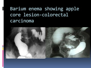 Interpret axr and imaging of gist system | PPTX