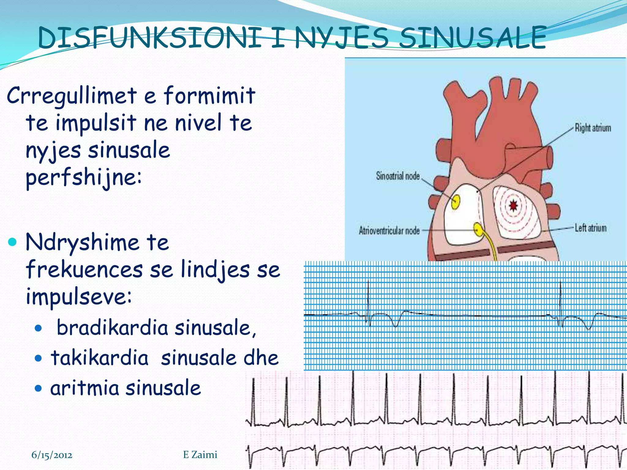 Interpretimi elektrokardiografik i crregullimeve te rritmit | PPSX