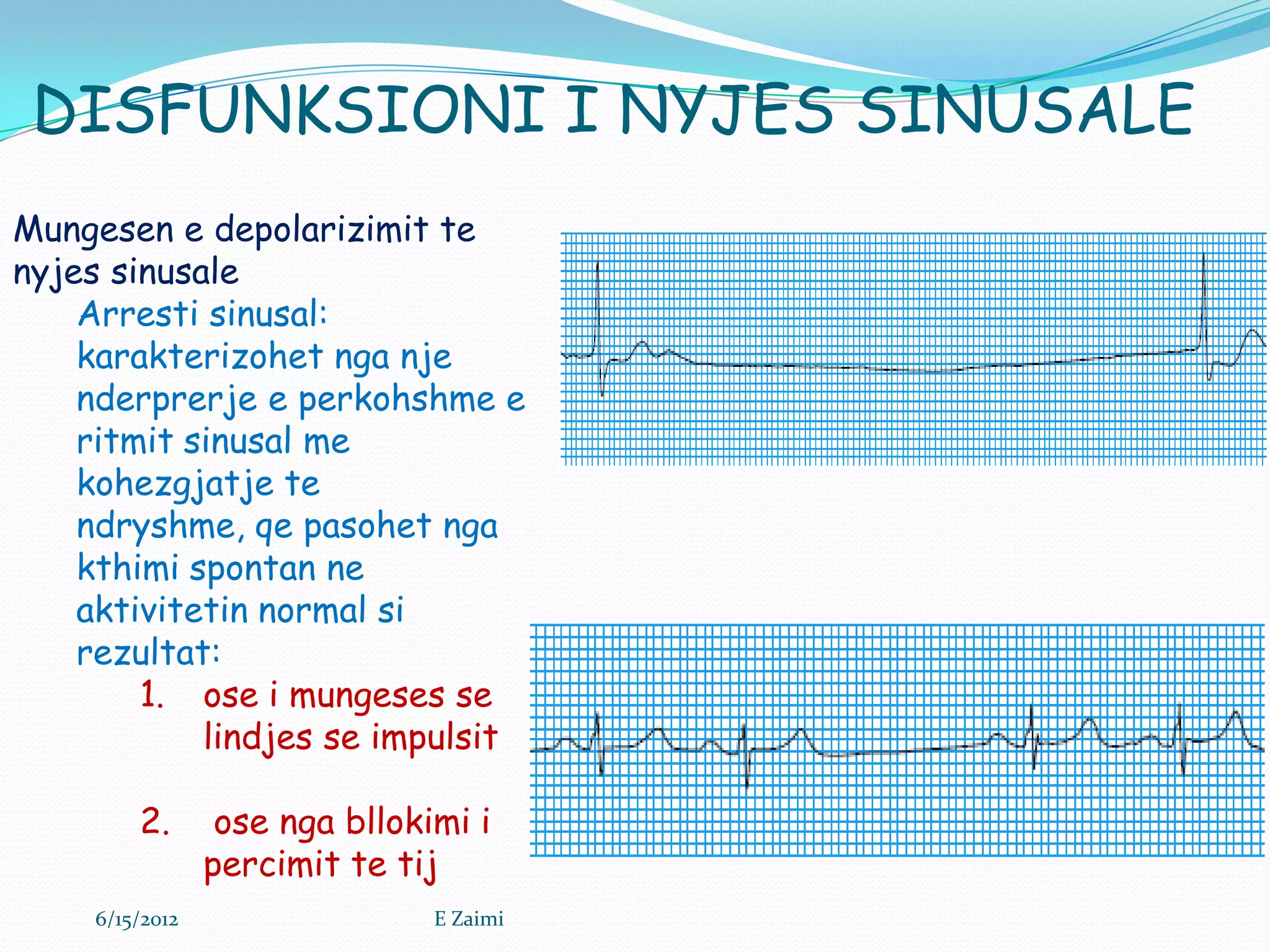 Interpretimi elektrokardiografik i crregullimeve te rritmit | PPSX