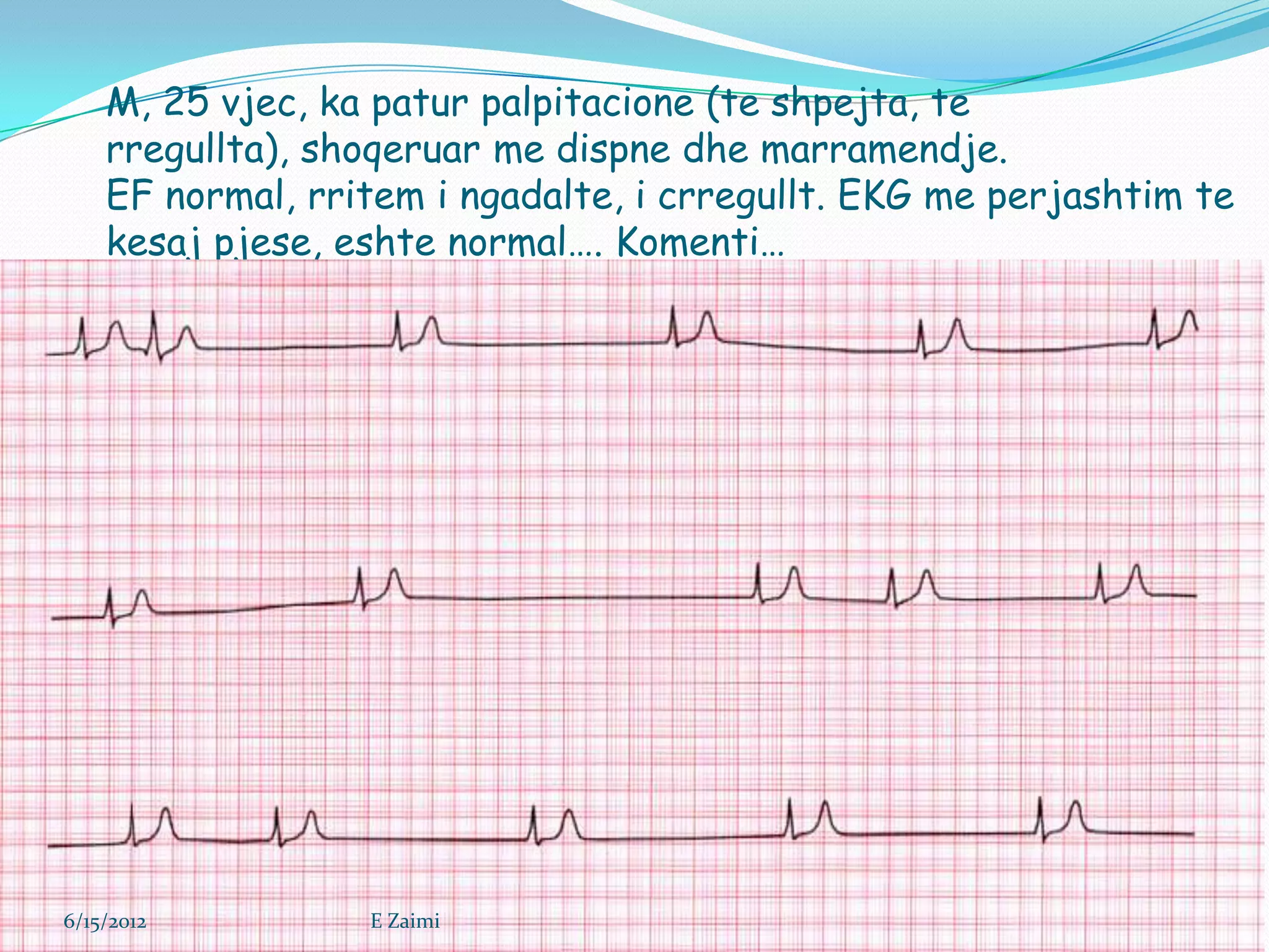 Interpretimi elektrokardiografik i crregullimeve te rritmit | PPSX