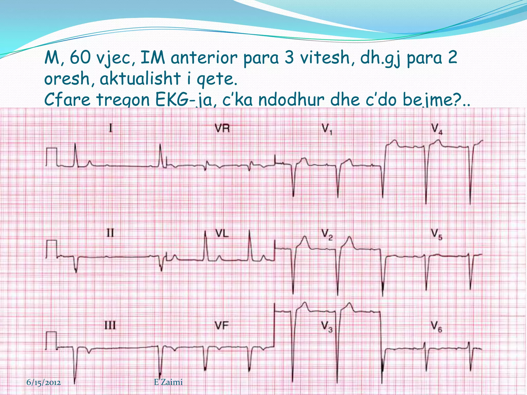 Interpretimi elektrokardiografik i crregullimeve te rritmit | PPSX