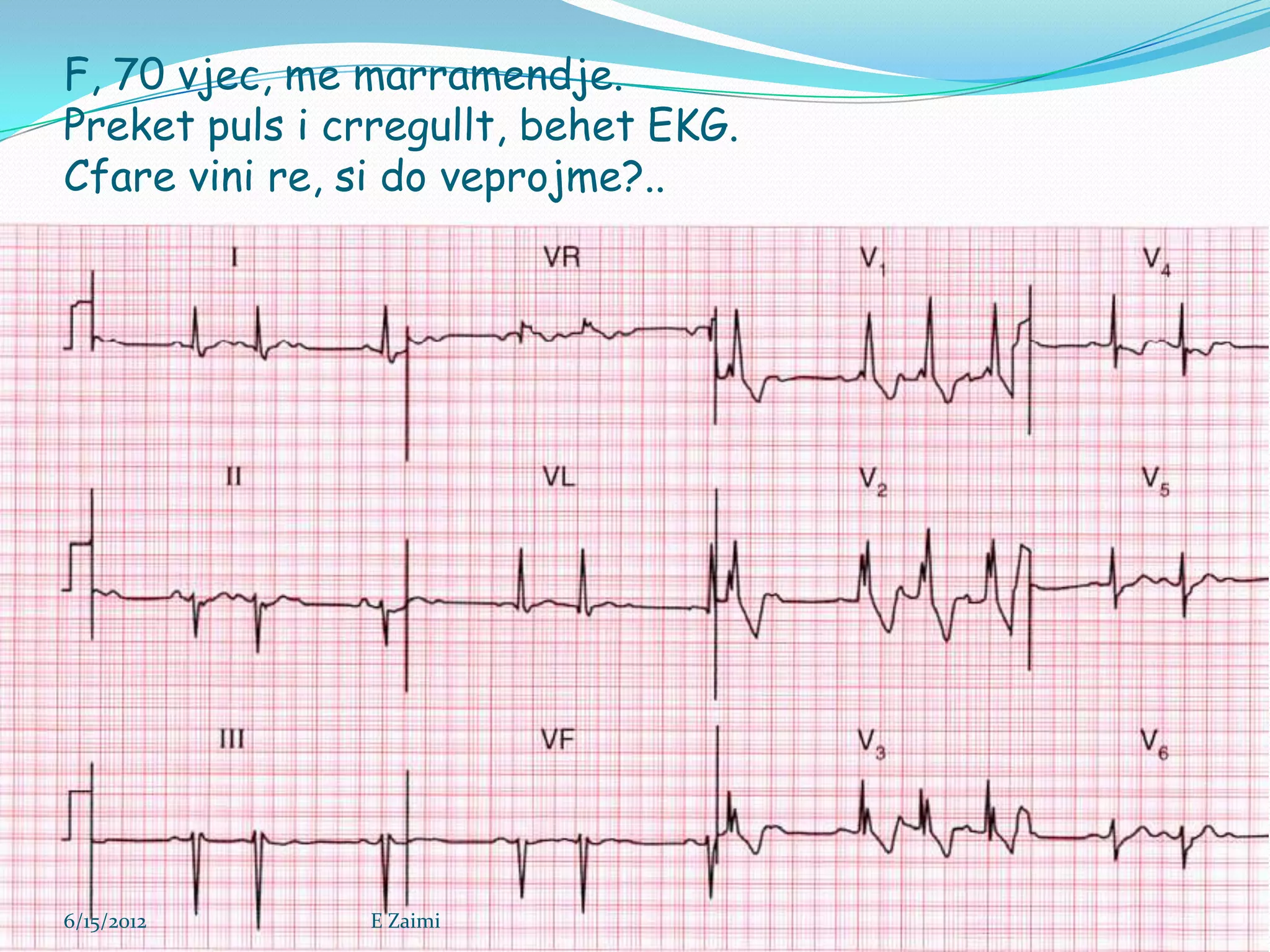 Interpretimi elektrokardiografik i crregullimeve te rritmit | PPSX