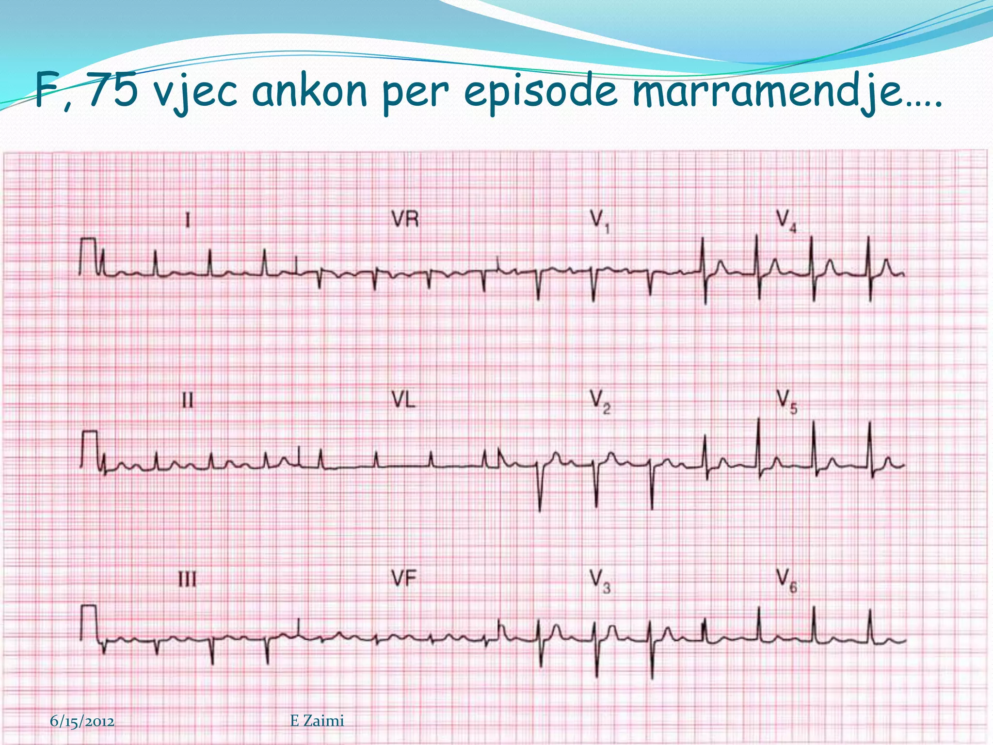 Interpretimi elektrokardiografik i crregullimeve te rritmit | PPSX
