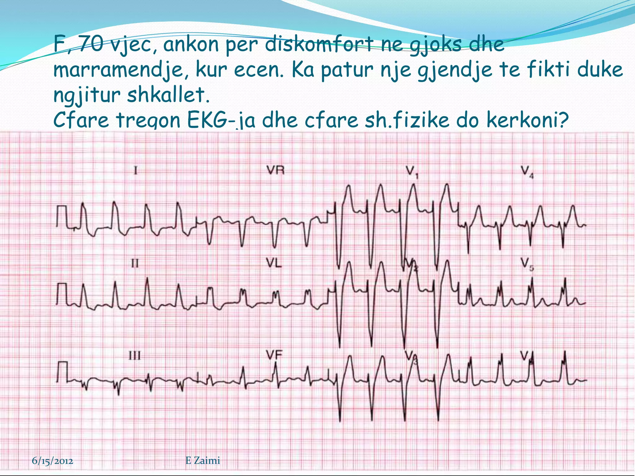 Interpretimi elektrokardiografik i crregullimeve te rritmit | PPSX
