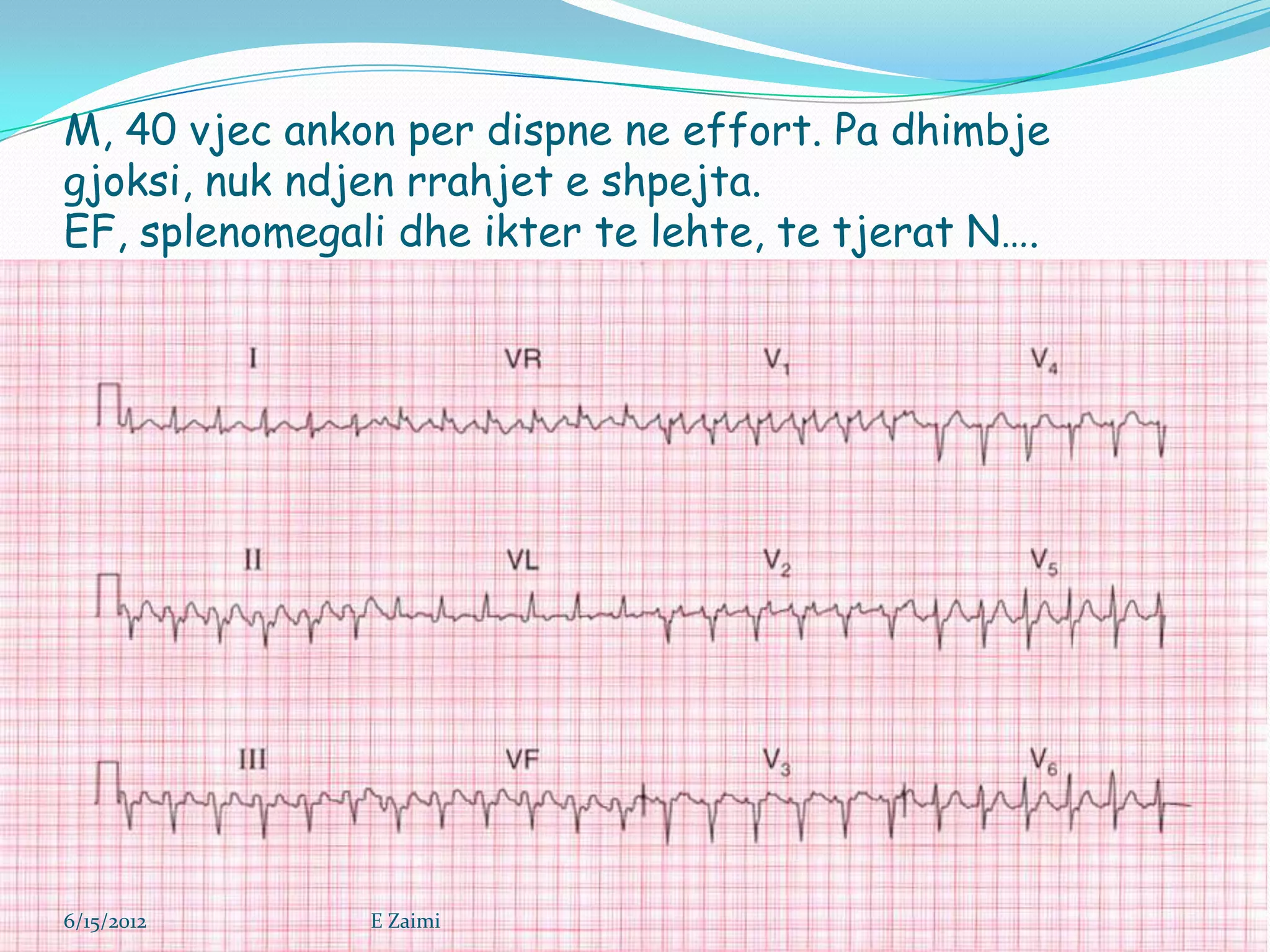 Interpretimi elektrokardiografik i crregullimeve te rritmit | PPSX