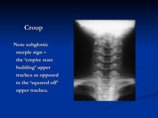 Interpreting chest xray and airway.ppt in emergency room | PPT