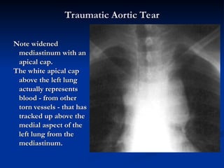 Interpreting chest xray and airway.ppt in emergency room | PPT