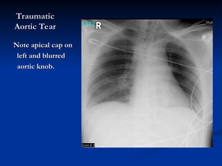 Interpreting chest xray and airway.ppt in emergency room | PPT
