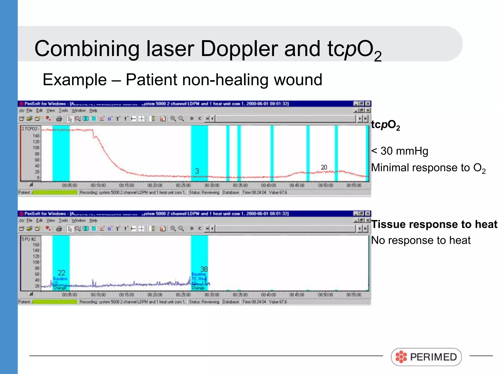 Interpreting tcpo2 curves and results | PDF
