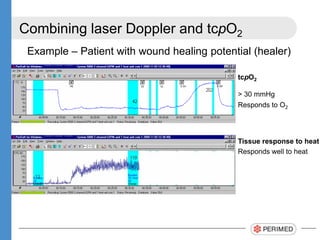 Interpreting tcpo2 curves and results | PDF