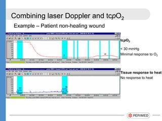 Interpreting tcpo2 curves and results | PDF