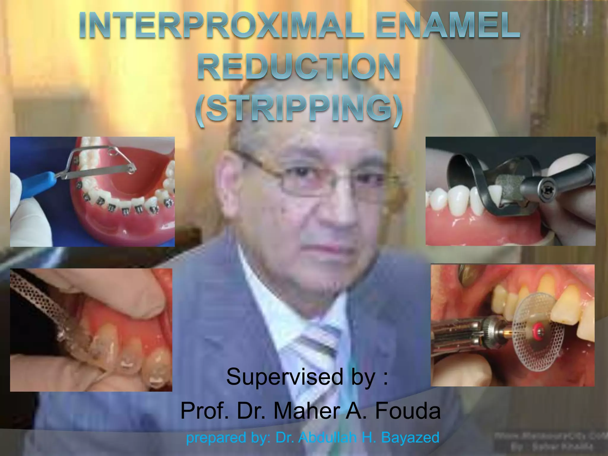 Interproximal Enamel Reduction (stripping) | PPTX