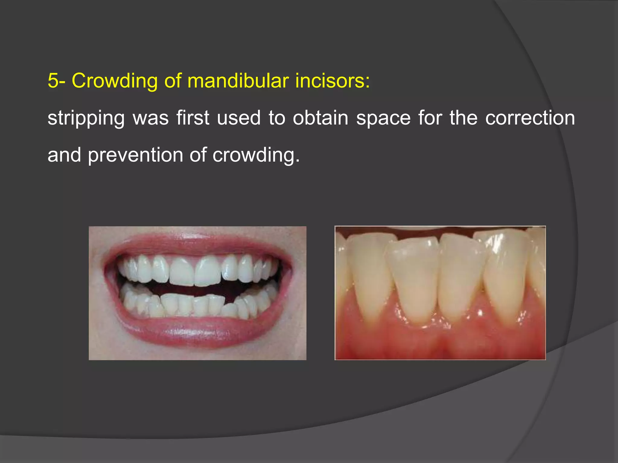 Interproximal Enamel Reduction (stripping) | PPTX