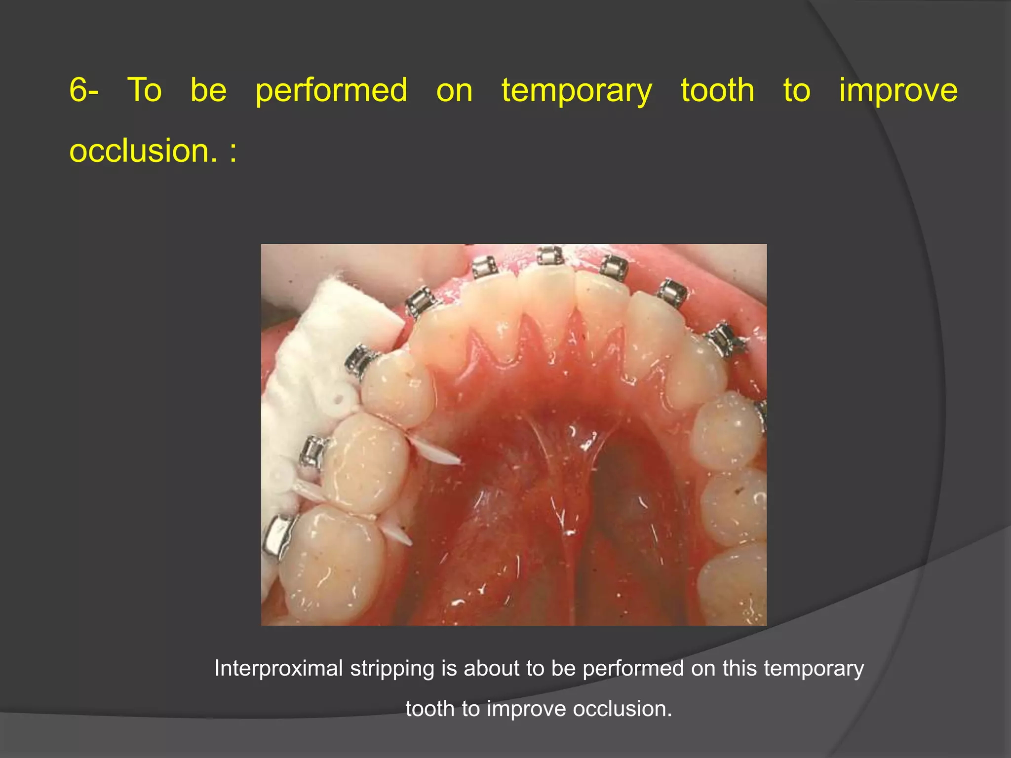 Interproximal Enamel Reduction (stripping) | PPTX