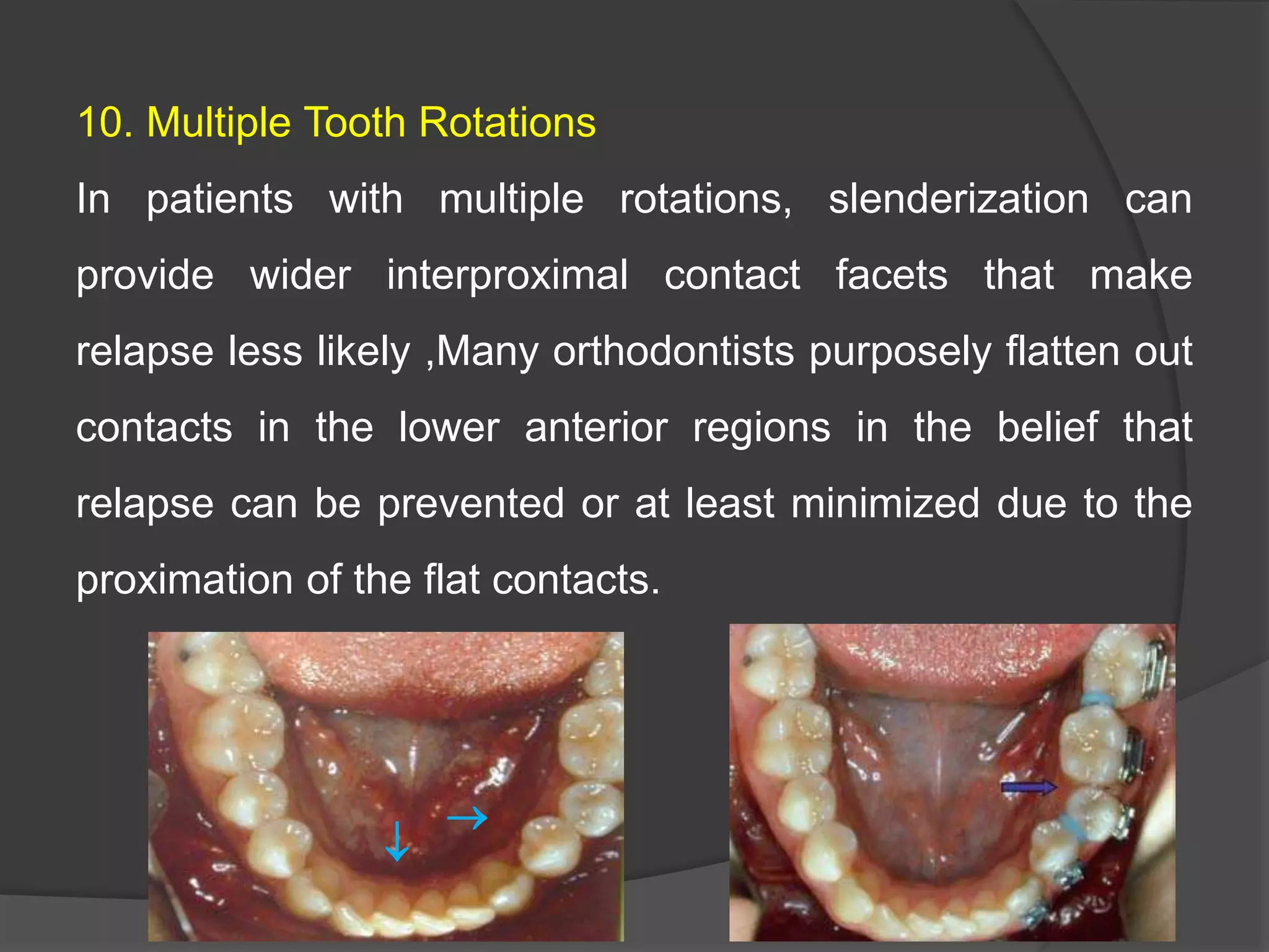 Interproximal Enamel Reduction (stripping) | PPTX