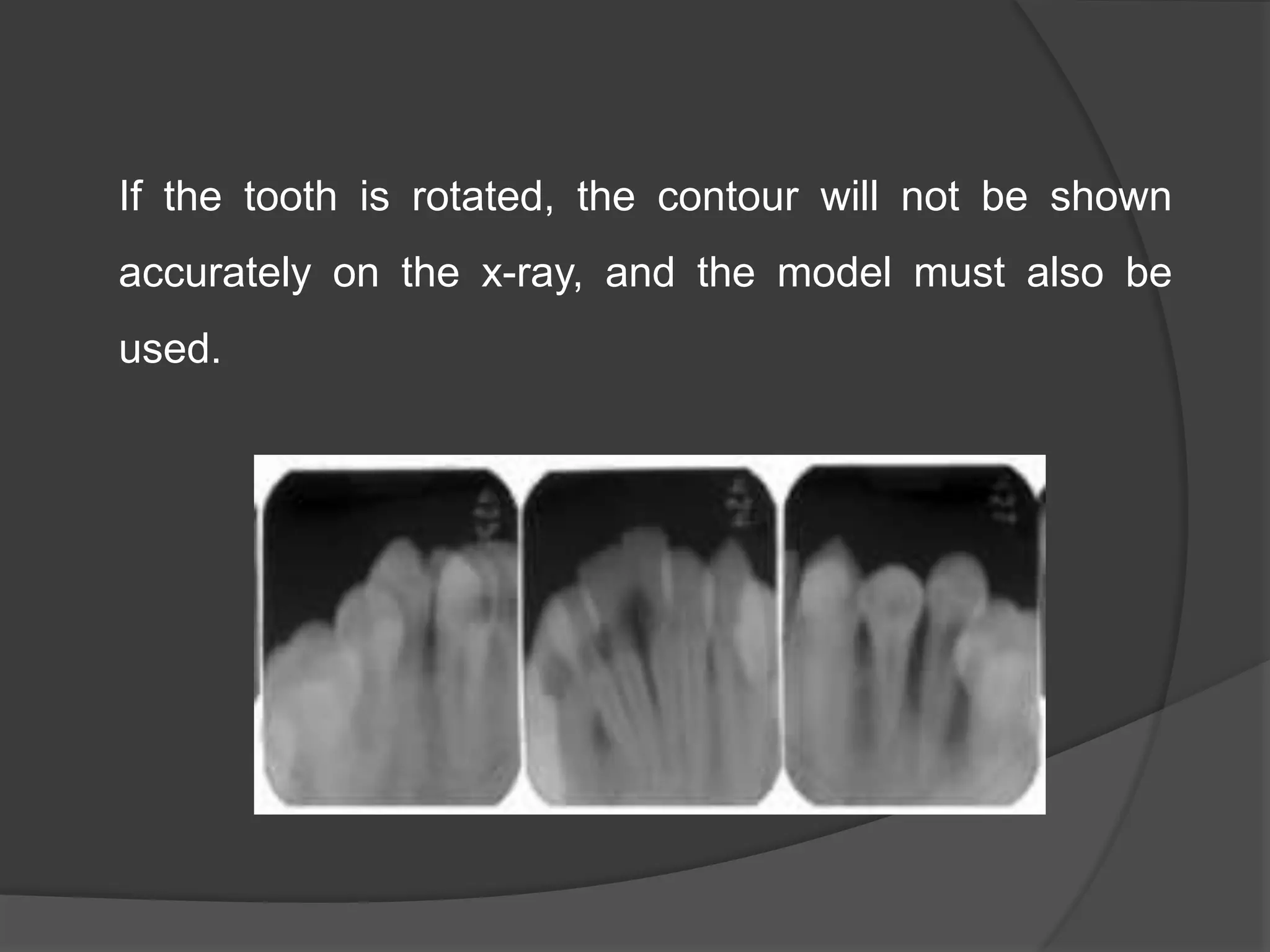 Interproximal Enamel Reduction (stripping) | PPTX