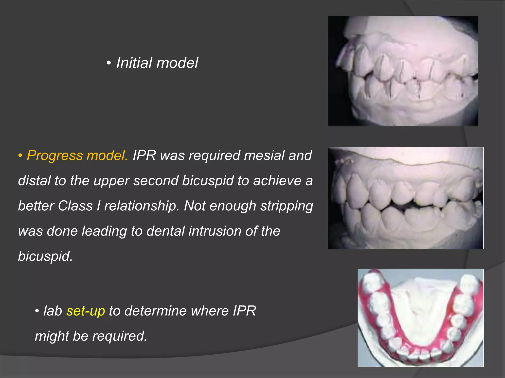 Interproximal Enamel Reduction (stripping) | PPTX
